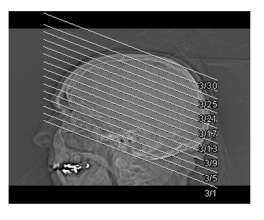 CT Head Without Contrast