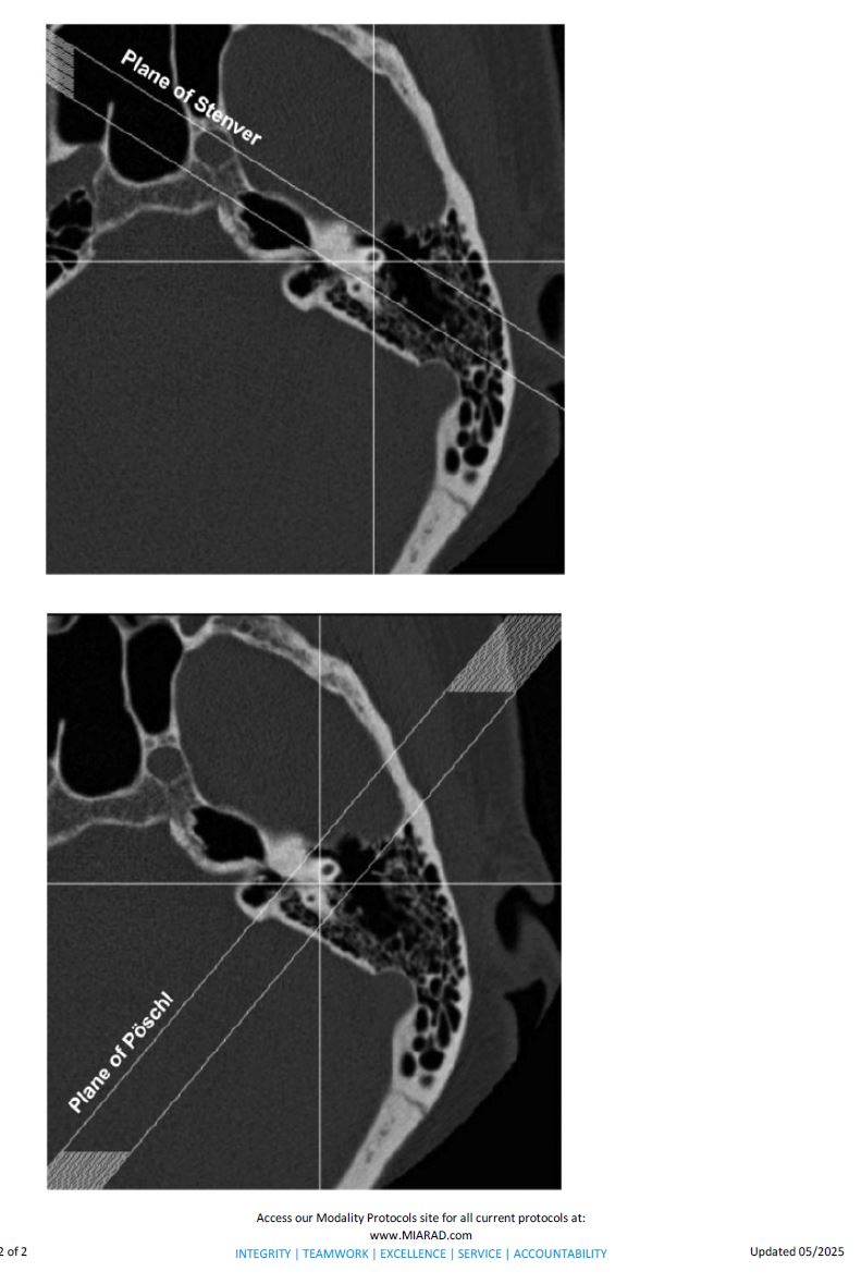 CT Temporal Bone CTA-CTV